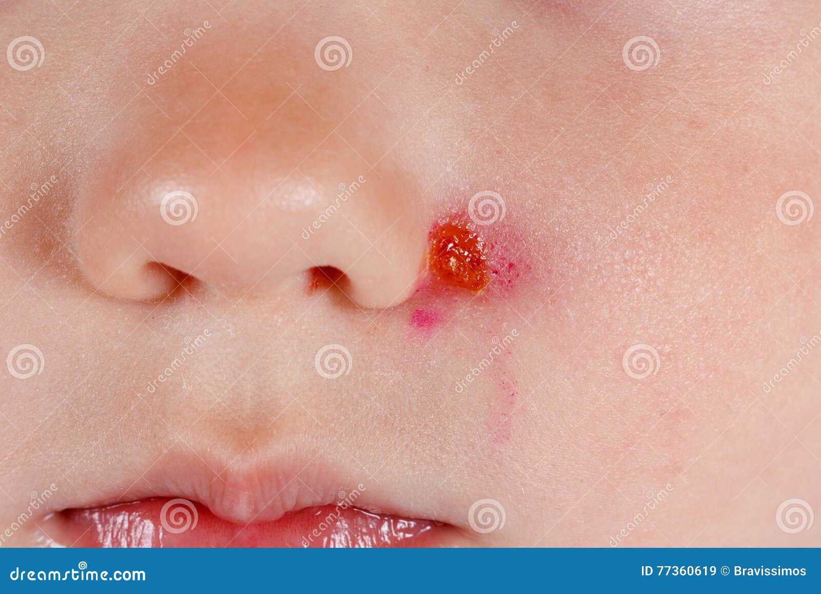 Treatment and Prevention of Insect Bites Stock Image - Image of acne ...