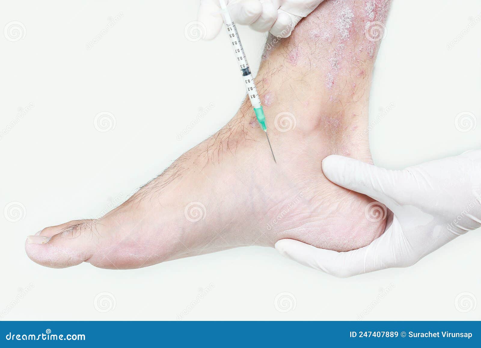 Treatment of psoriasis stock image. Image of psoriasis - 247407889