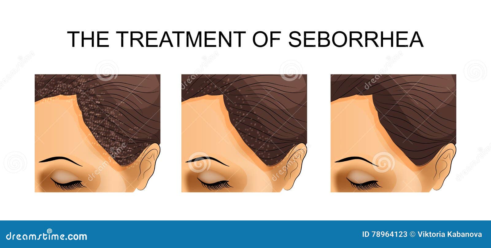 Oily Seborrhea Of Skin And Hair. Dandruff, Seborrheic Dermatitis ...