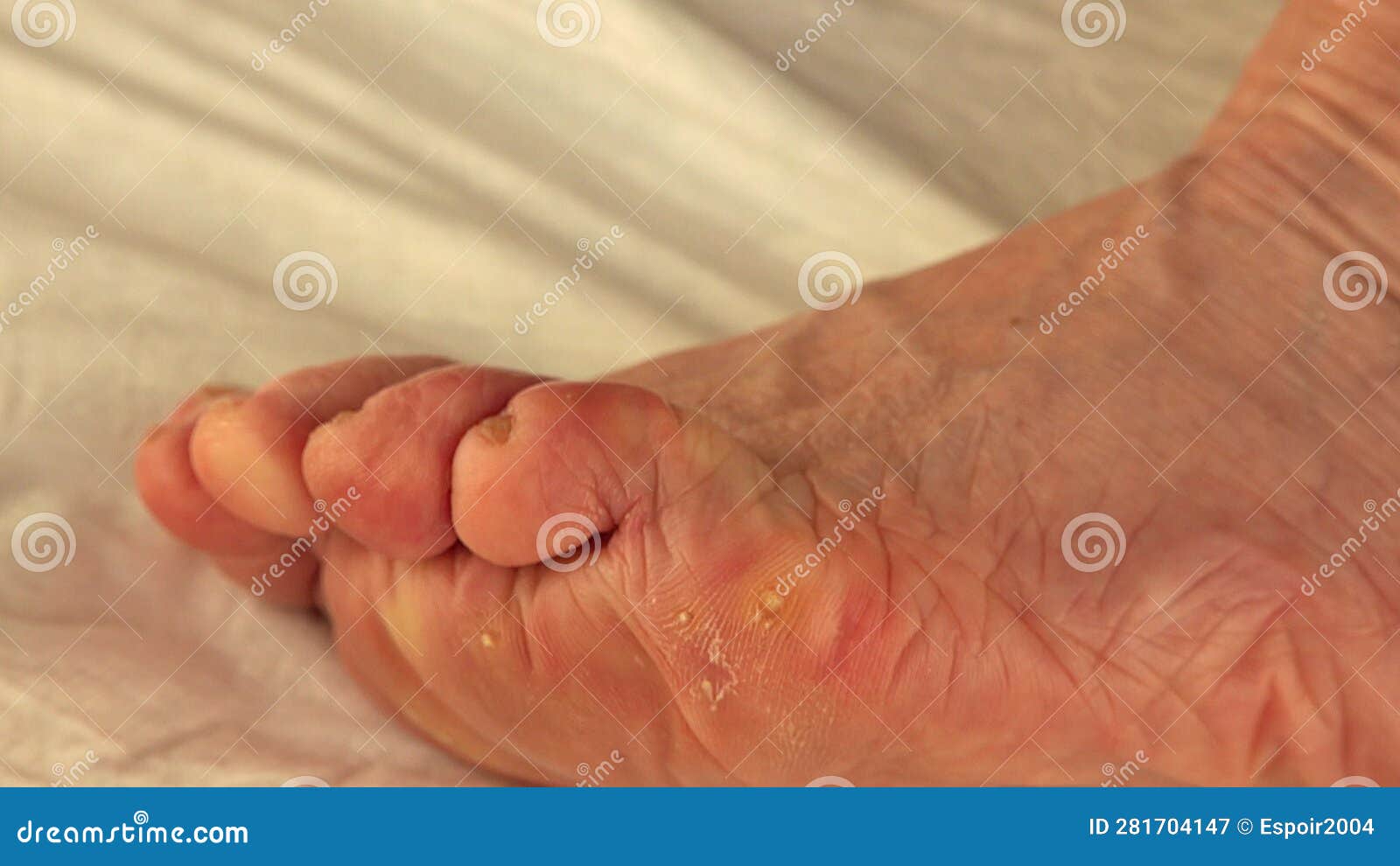 Treatment of warts stock video. Video of feet, ache - 281704147