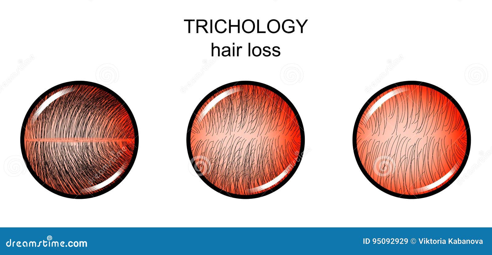 Trichology. hair loss stock vector. Illustration of care - 95092929