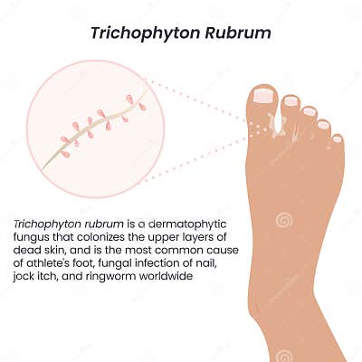 Trichophyton Rubrum Fungus Vector Illustration Graphic Stock Vector ...
