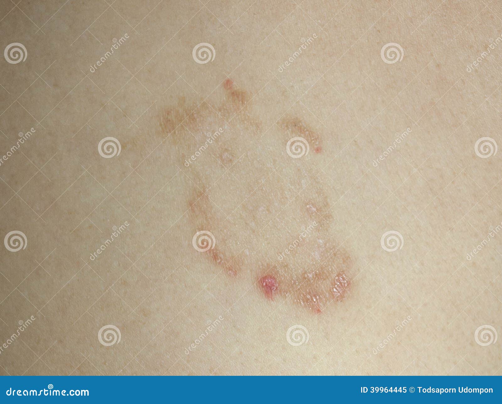 Tricofitosi immagine stock. Immagine di umano, asiatico - 39964445