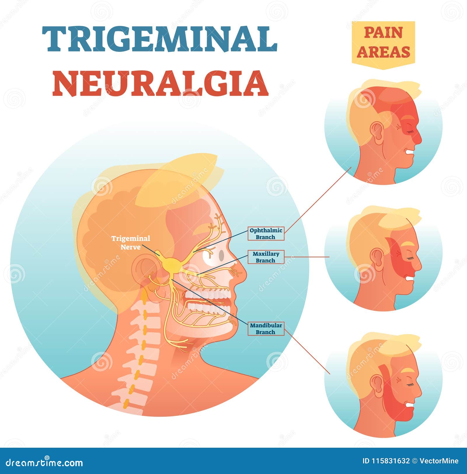 Atypical Trigeminal Neuralgia Occipital Neuralgia Dental Anatomy | My ... Atypical Trigeminal Neuralgia Occipital Neuralgia Dental Anatomy | My ...