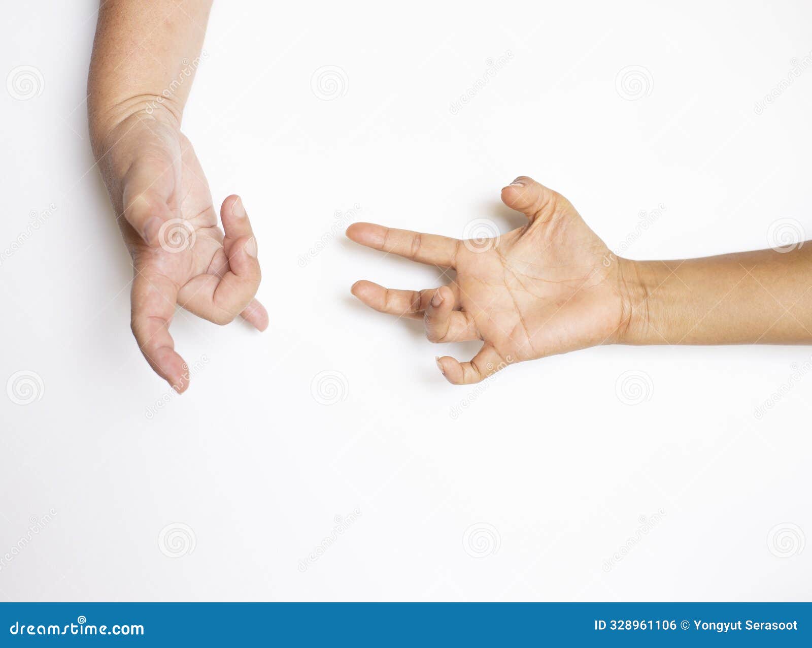 Trigger Finger a Defect in a Tendon Causing a Finger To Jerk or Snap ...