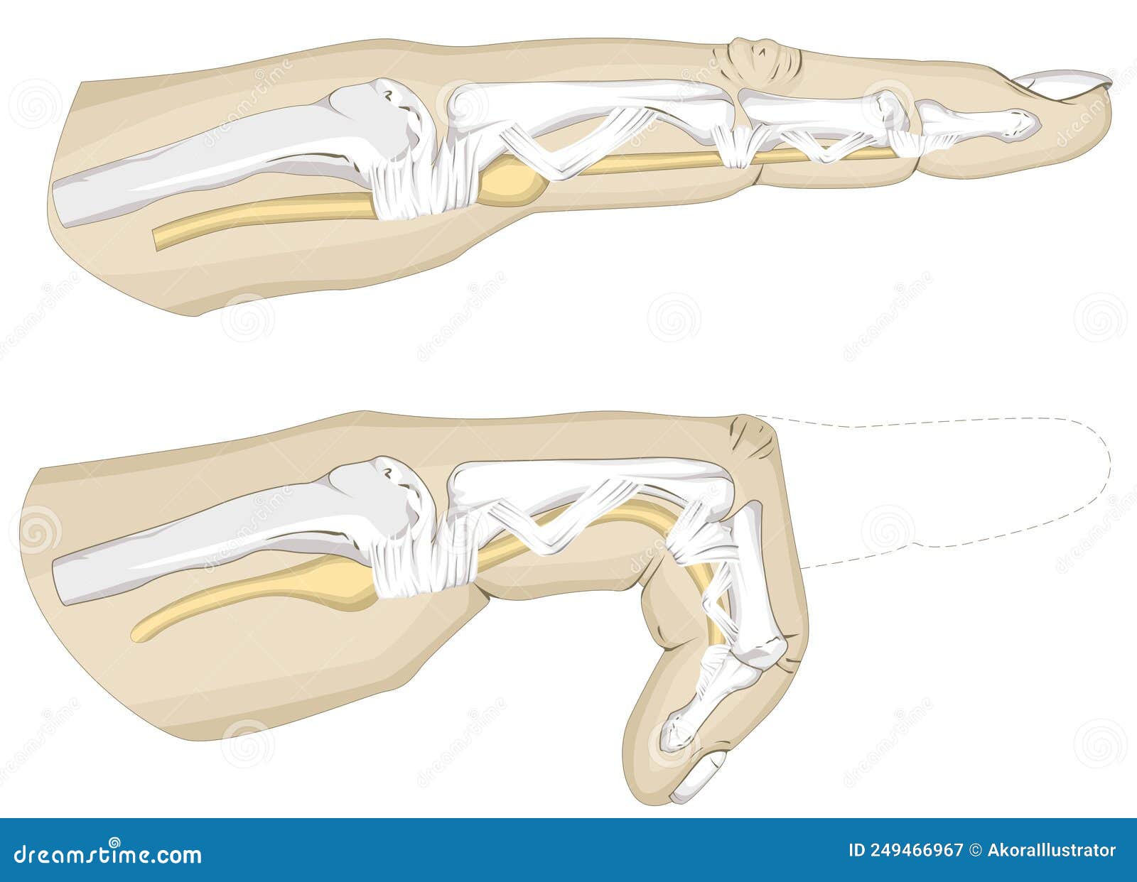 Trigger Finger Causes And Symptoms Illustration Cartoon Vector ...