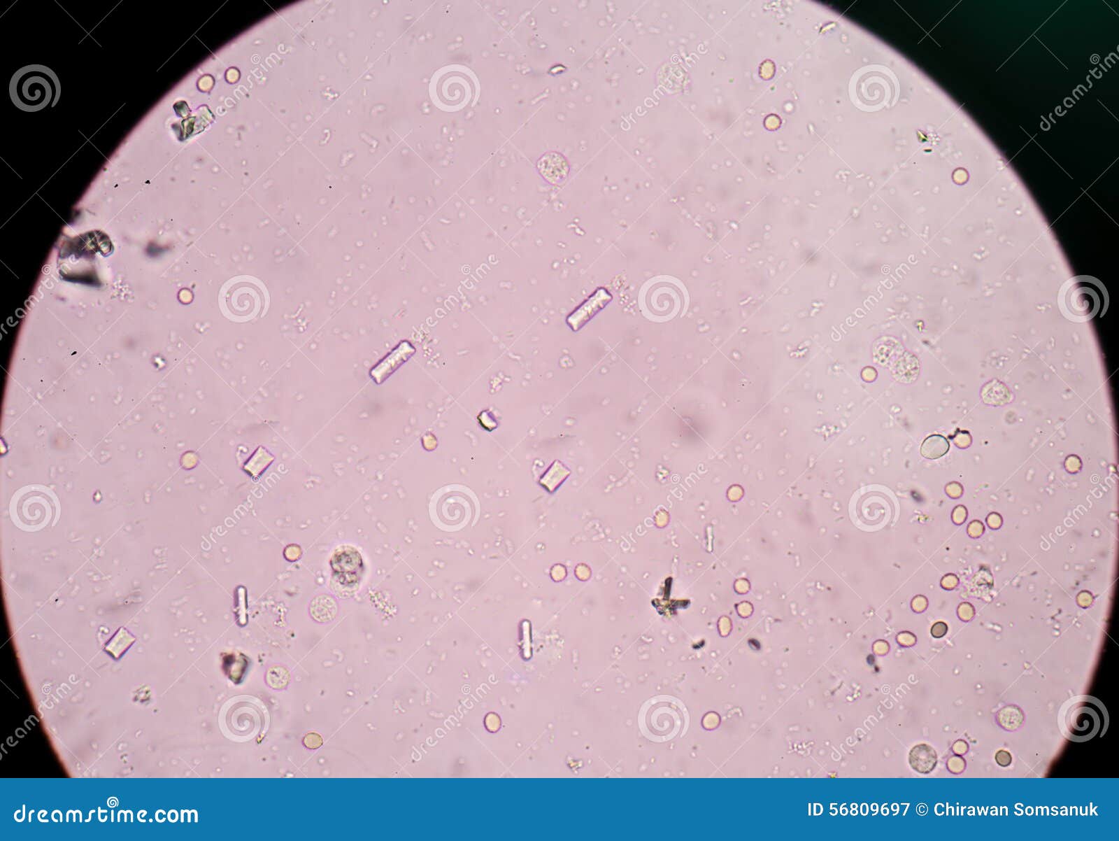 Triple Phosphate Crystals In Urine