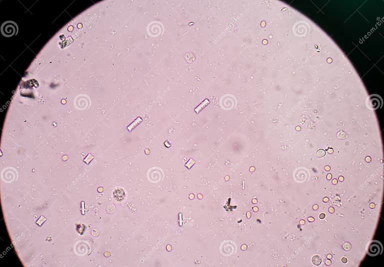 Triple phosphate crystals stock image. Image of infected - 56809697