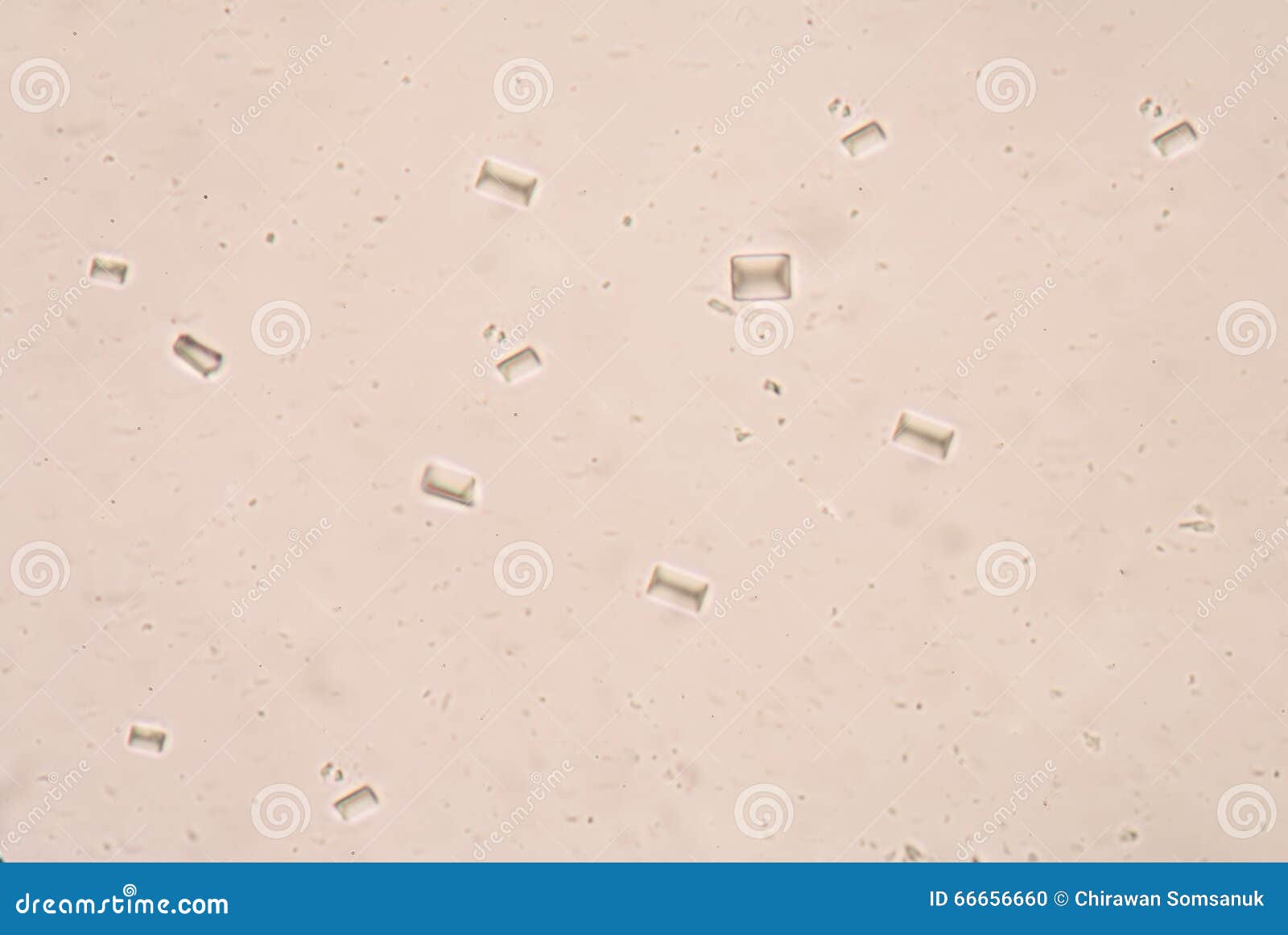 Triple Phosphate Crystals In Human Urine Sediment Royalty-Free Stock ...