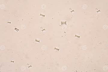 Triple Phosphate Crystals in Human Urine Stock Photo - Image of ...