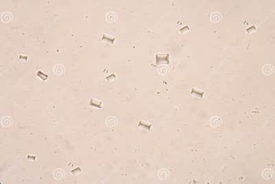Triple Phosphate Crystals in Human Urine Stock Photo - Image of ...