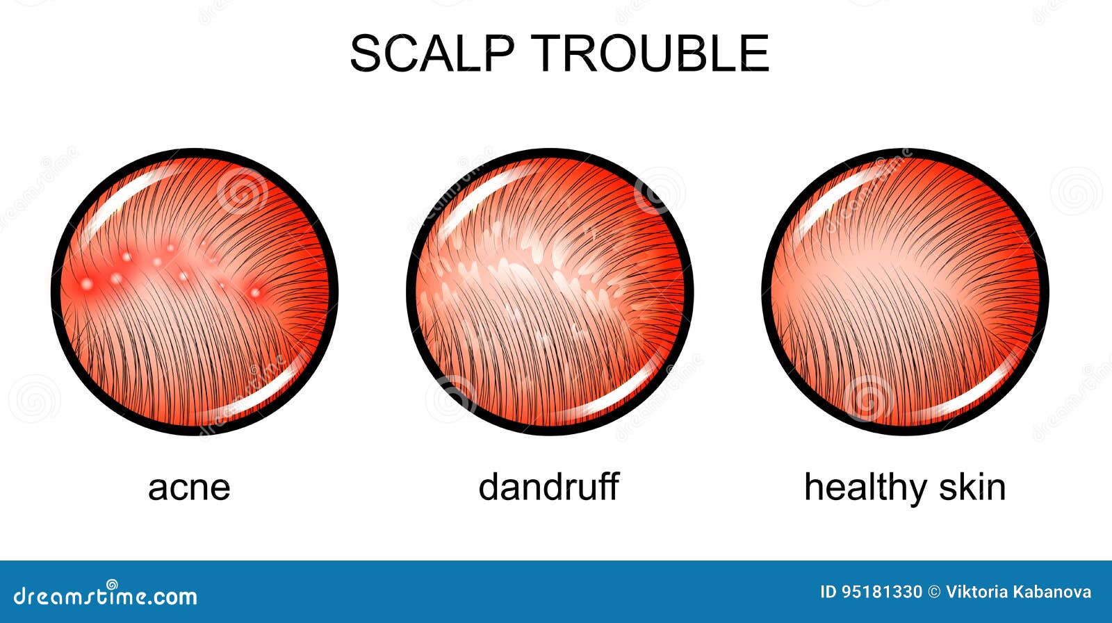 Troubled Scalp. Dermatology Stock Vector - Illustration of female ...