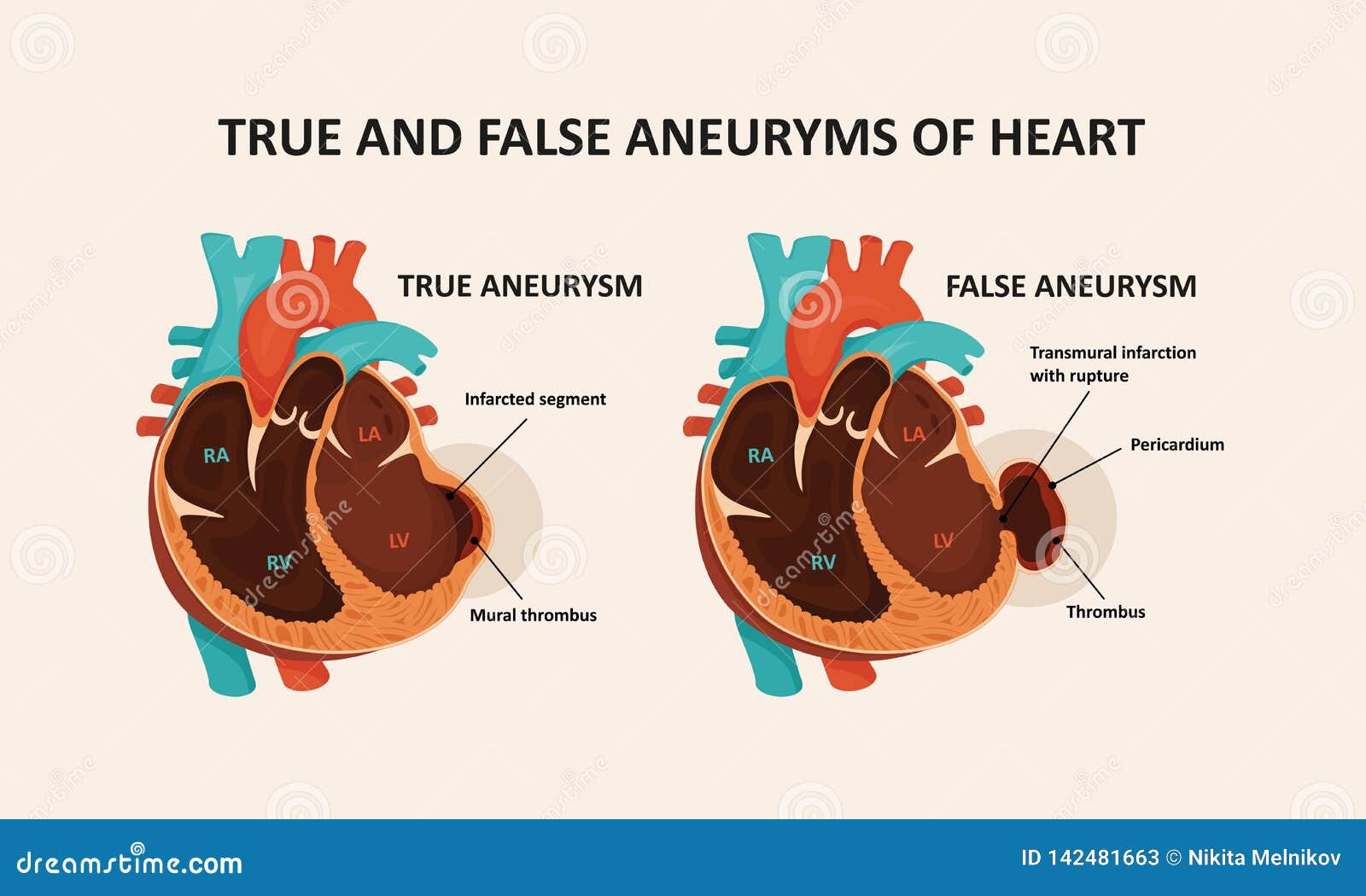 Pseudoaneurysm Vs Aneurysm