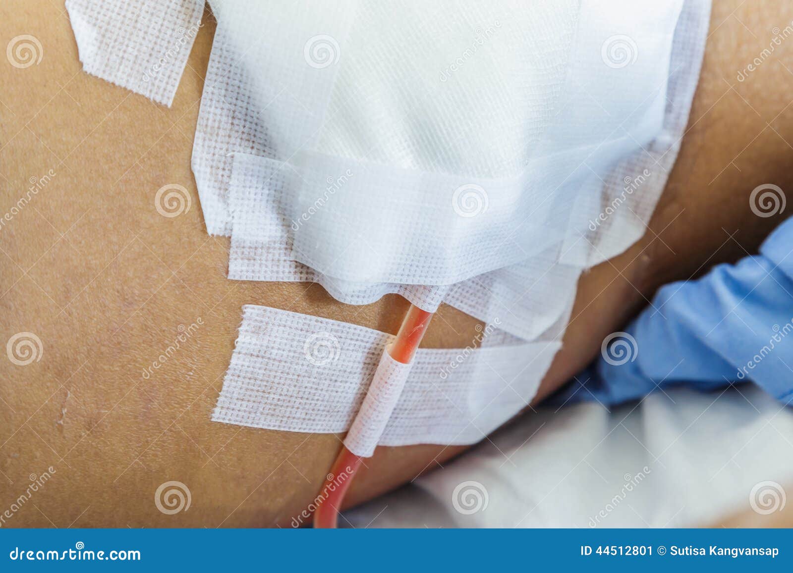 Tube Of Fluid Drain From Patient Stock Image - Image: 44512801