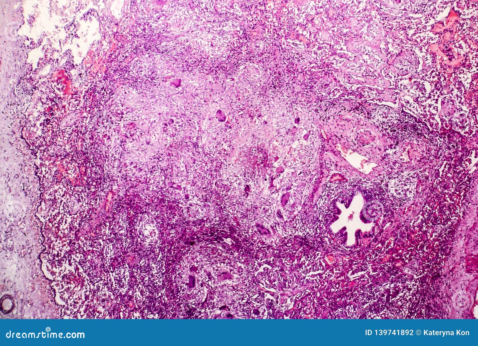 Tubercle, light micrograph stock photo. Image of tubercle - 139741892