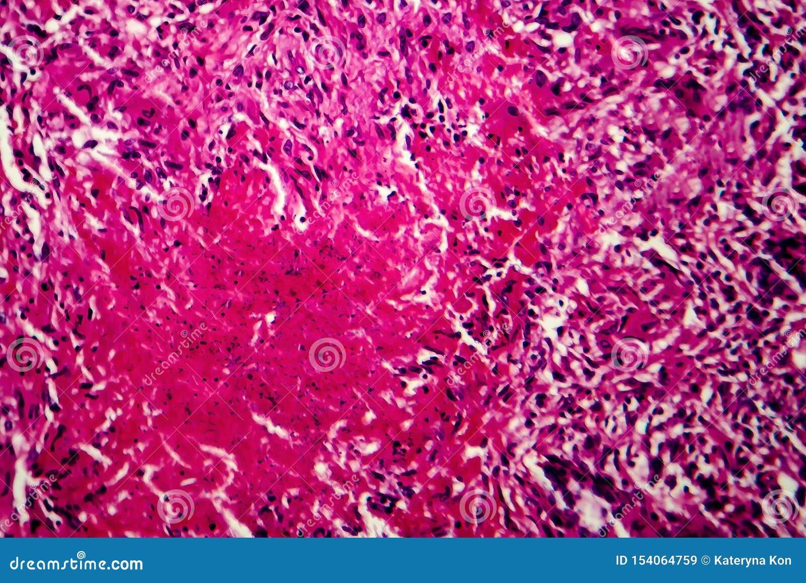 Tuberculose Miliary, Micrographe L?ger Image stock - Image du microbe ...