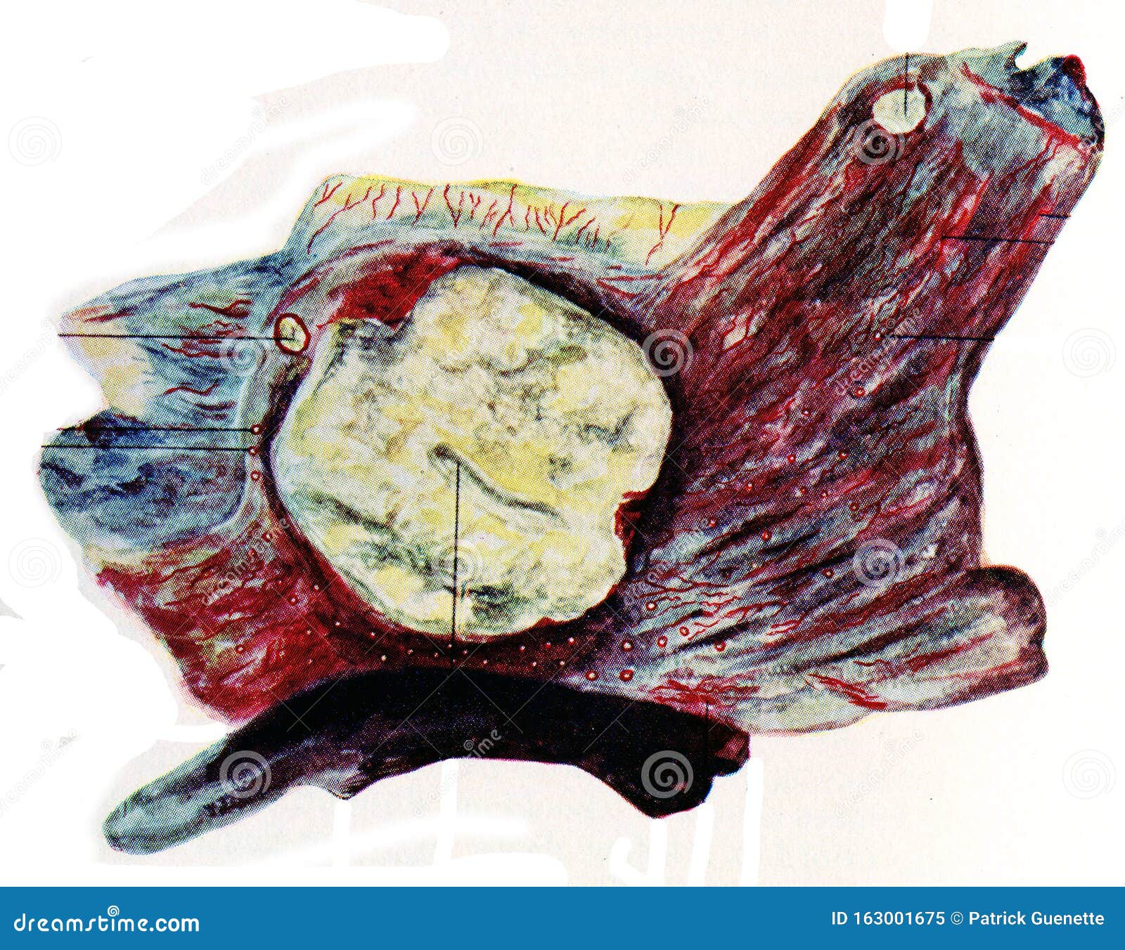 Tuberculosis of the Bladder, Vintage Engraving Stock Illustration ...