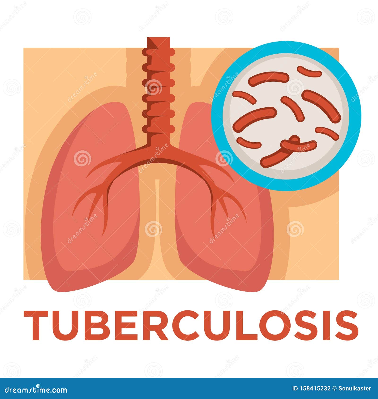 Tuberculosis Disease, Infected Lungs, Pulmonary Illness, Medicine Stock ... Tuberculosis Disease, Infected Lungs, Pulmonary Illness, Medicine Stock ...