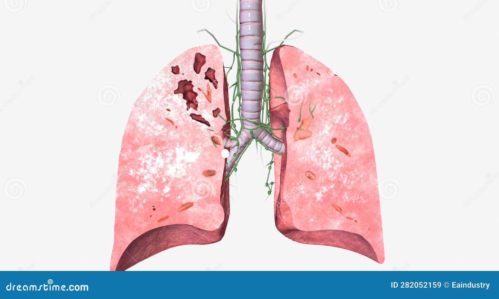 The Tuberculosis EarlyIntermediate in Lungs Stock Illustration ...