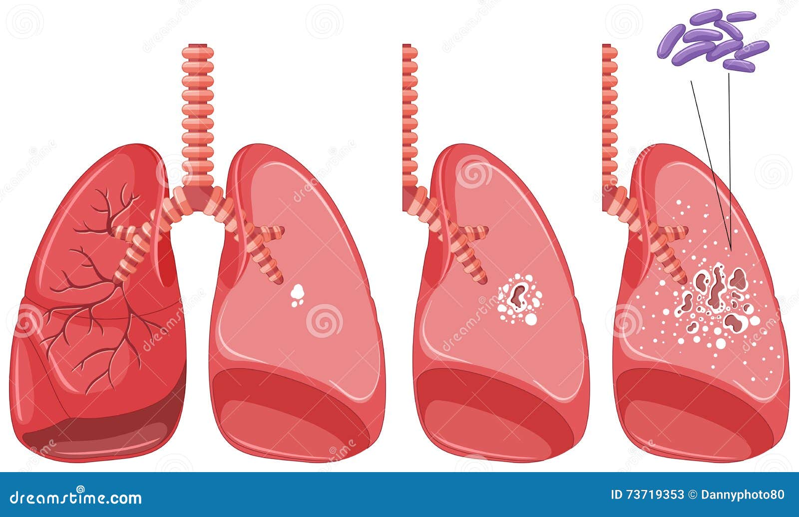 Tuberculosis En Pulmones Humanos Ilustración del Vector - Imagen: 73719353