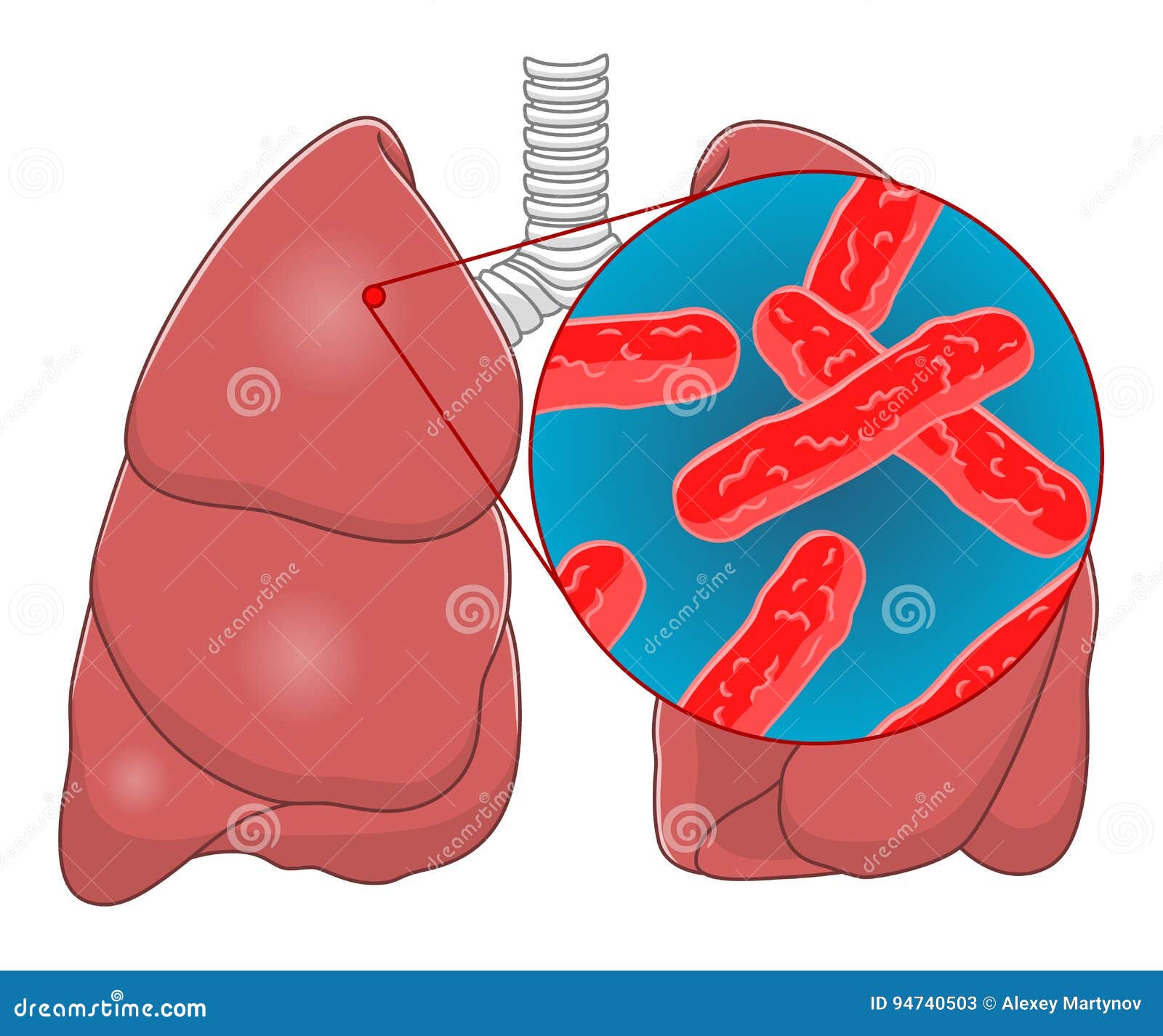Tuberculosis stock vector. Illustration of bacillus, human - 94740503
