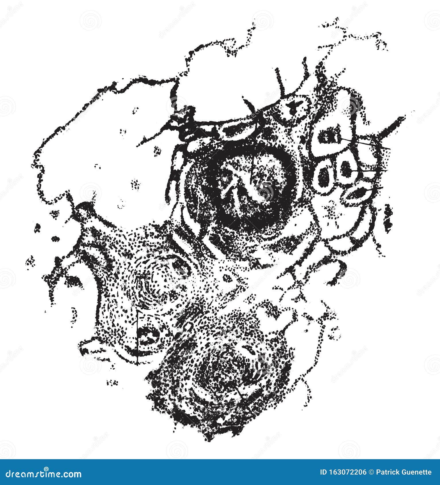 Tuberculosis. Lung Disease. Tubercle Bacillus. Vector Illustration On A ...