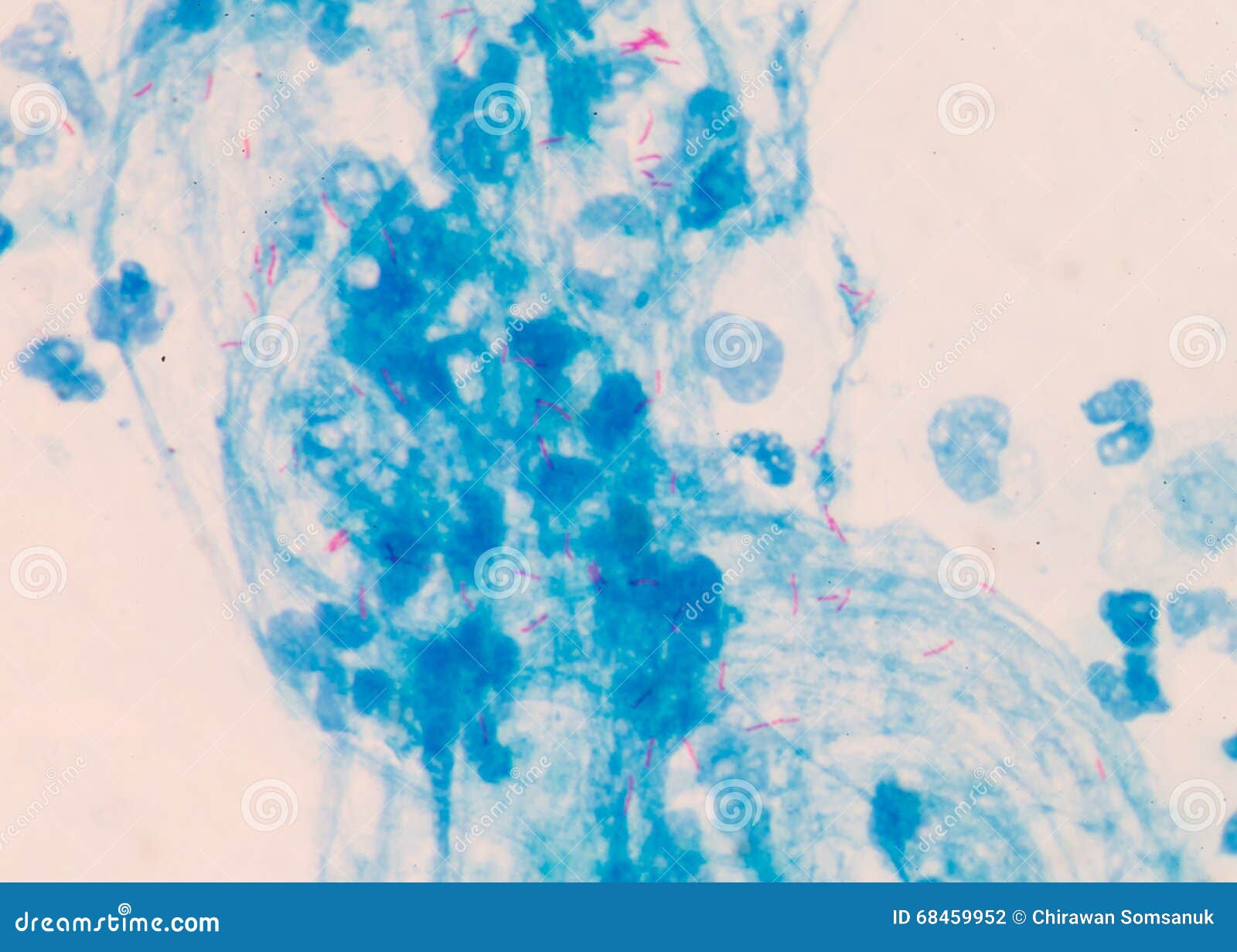 Tuberculosis Micro De La Bacteria Foto de archivo - Imagen de cuidado ...
