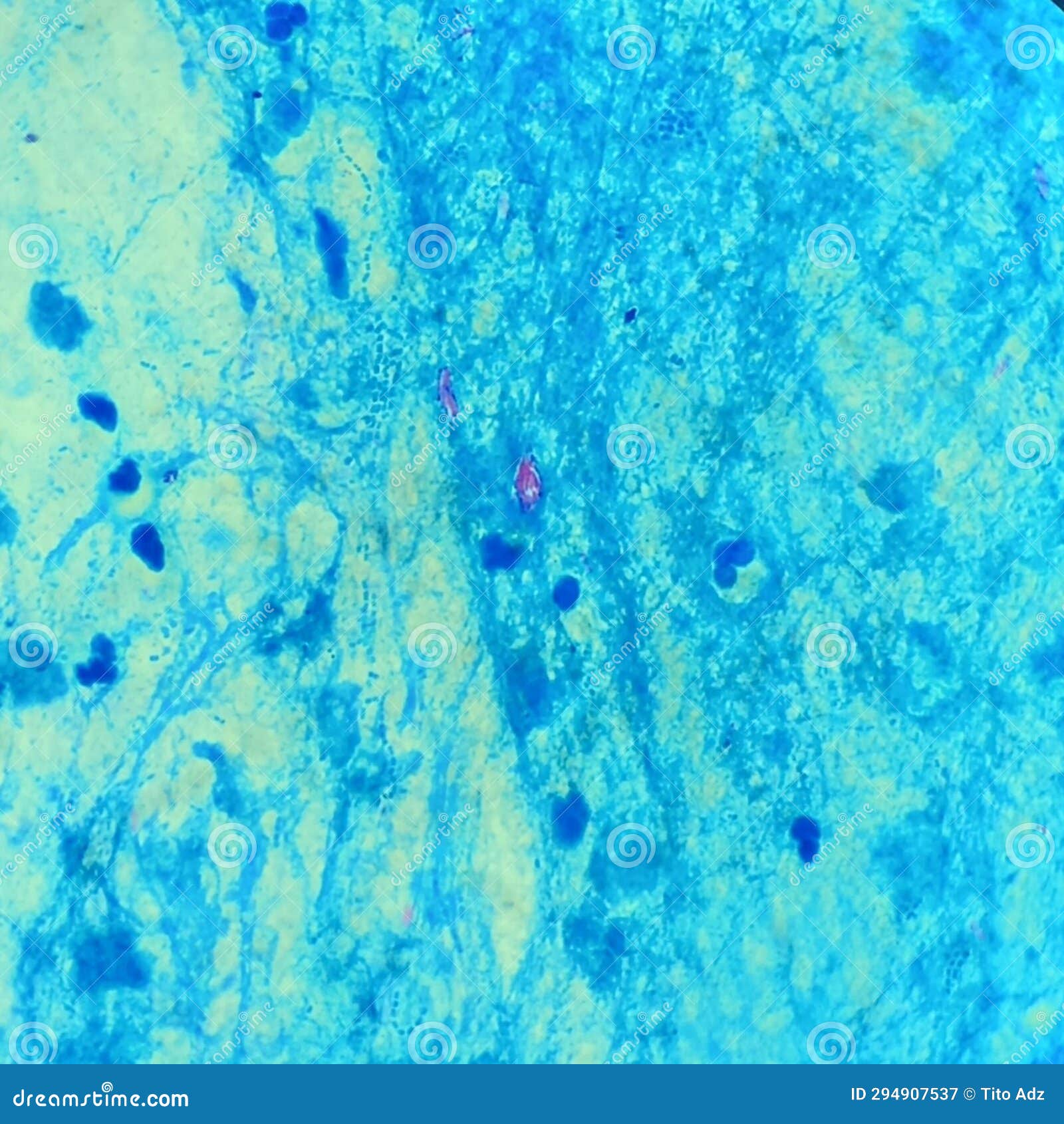 Tuberculosis on microscope stock image. Image of microscope - 294907537