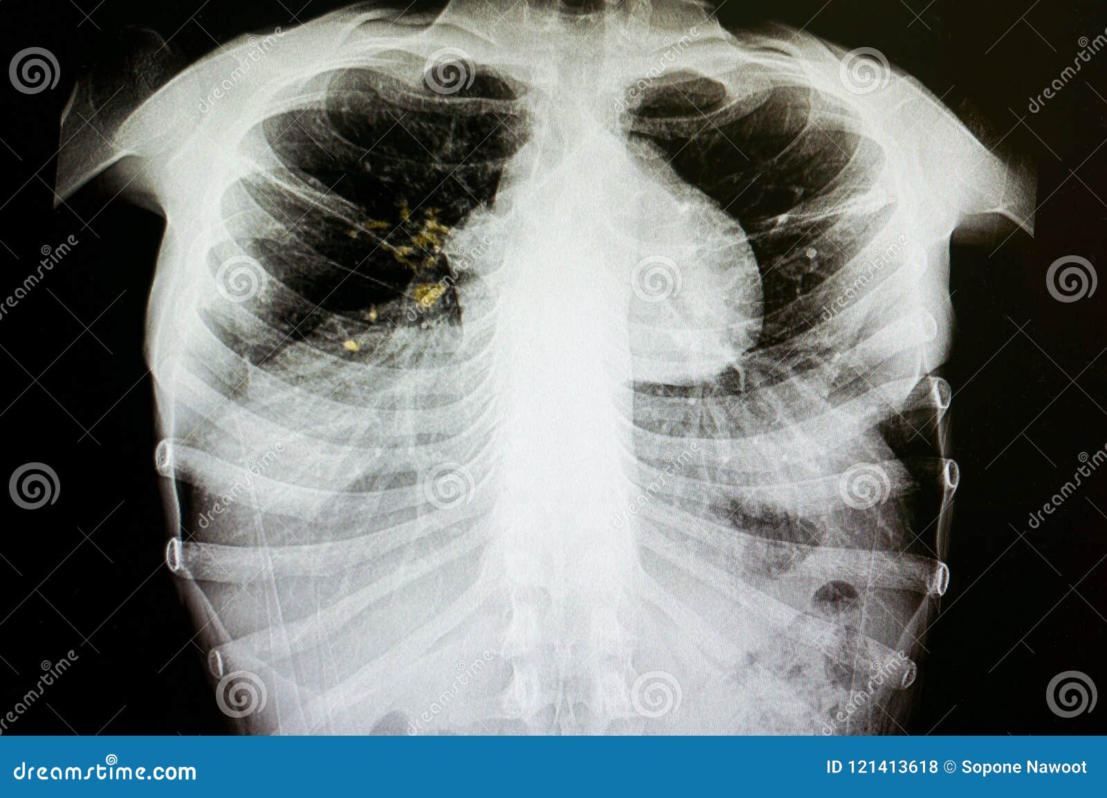 Tuberculosis pulmonar foto de archivo. Imagen de cuidado - 121413618
