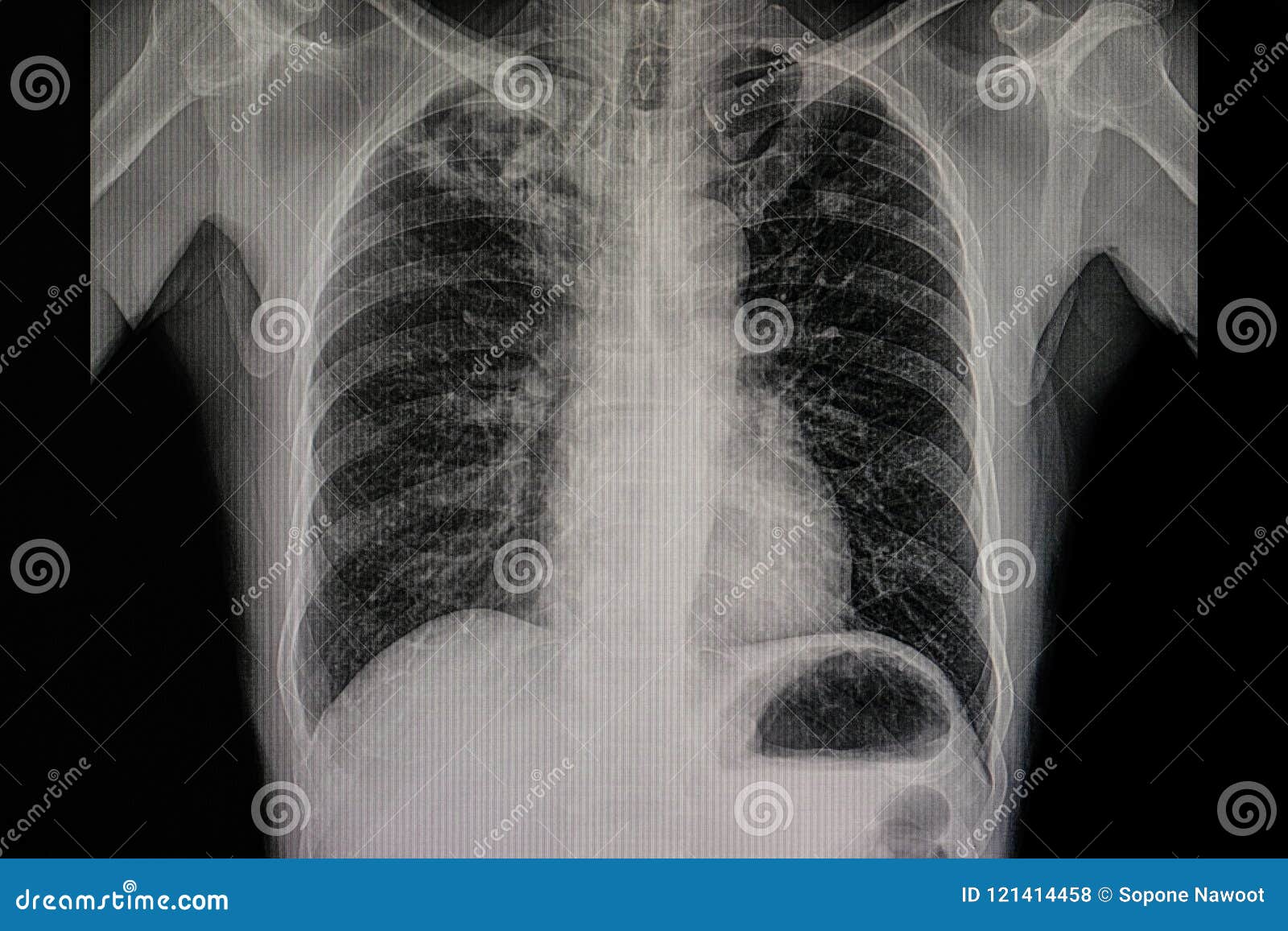 Tuberculosis pulmonar foto de archivo. Imagen de pulmonar - 121414458
