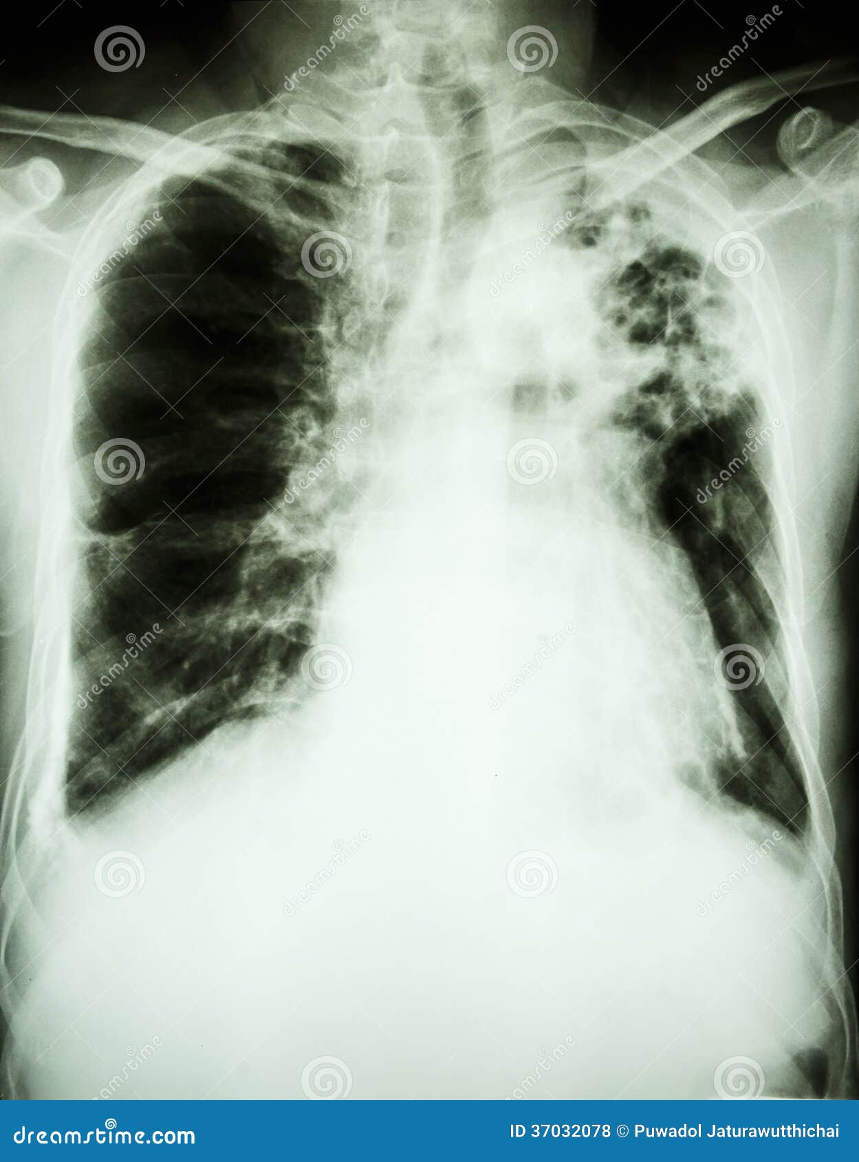 Tuberculosis pulmonar foto de archivo. Imagen de epidemia - 37032078