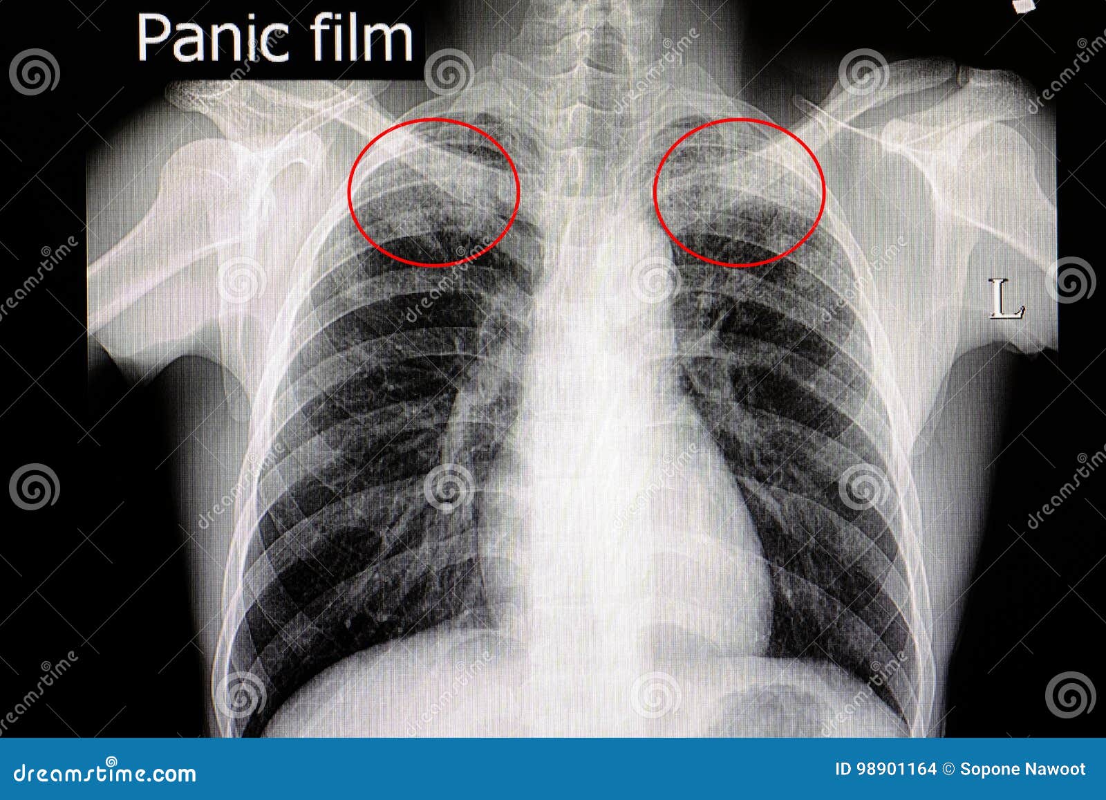 Tuberculosis pulmonar foto de archivo. Imagen de rayo - 98901164