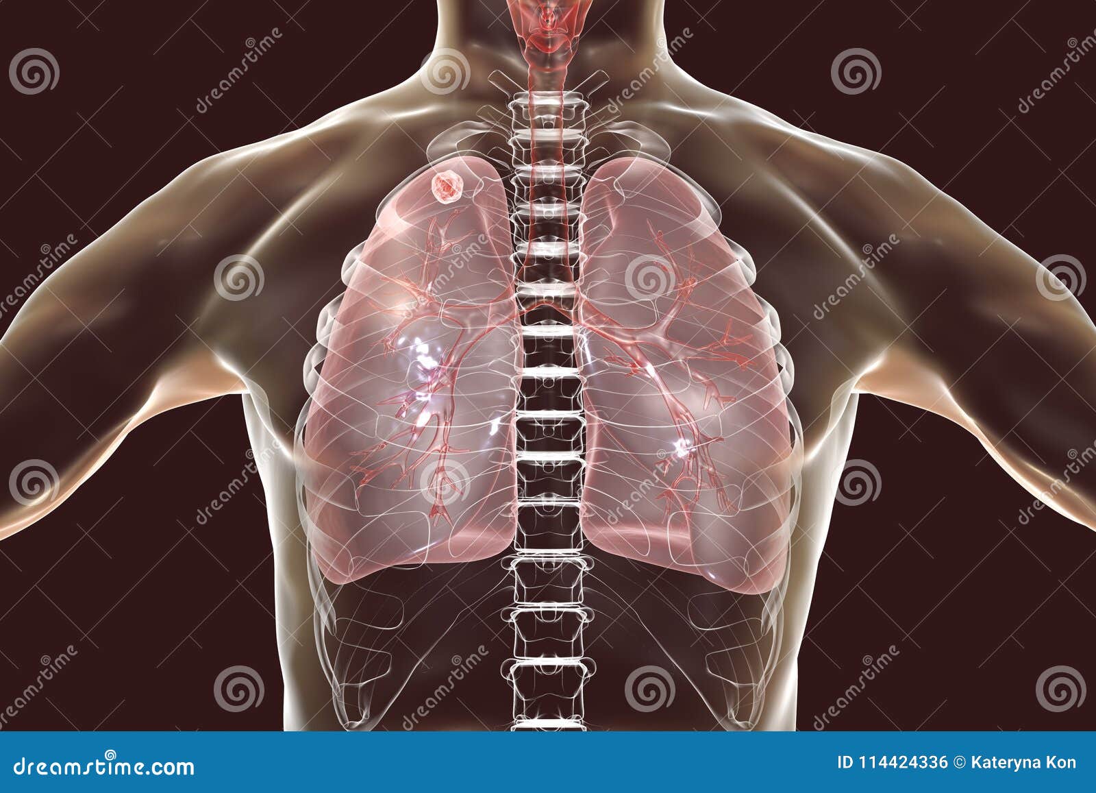 Tuberculosis Secundaria En Pulmones Stock de ilustración - Ilustración ...