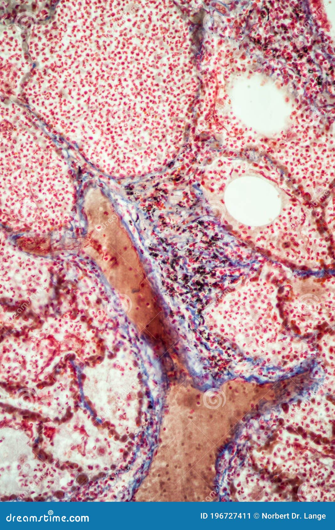 Tuberculosis tissue stock image. Image of lungs, enlargement - 196727411