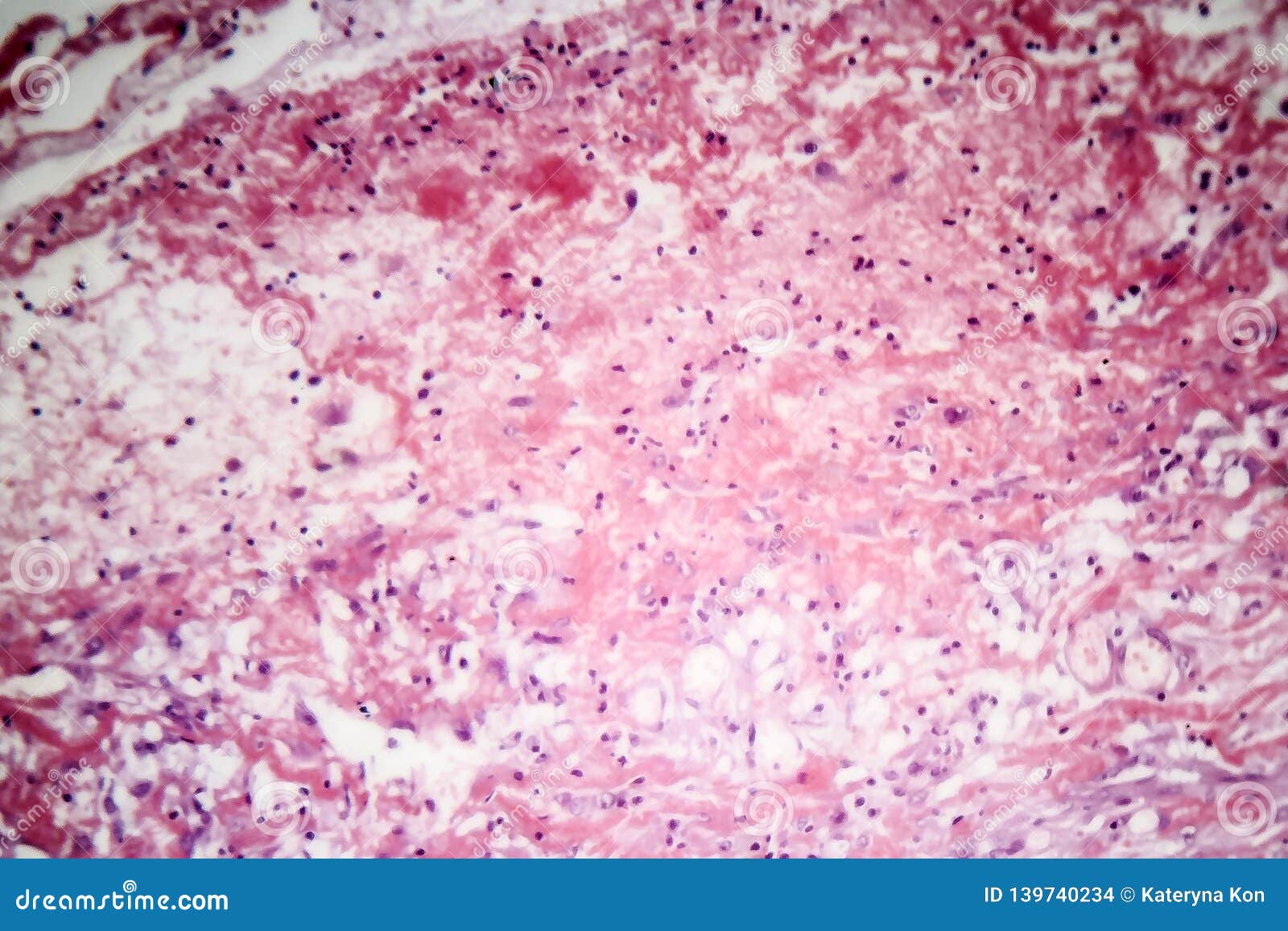 Tuberculous Pleurisy, Light Micrograph Stock Photo - Image of ...