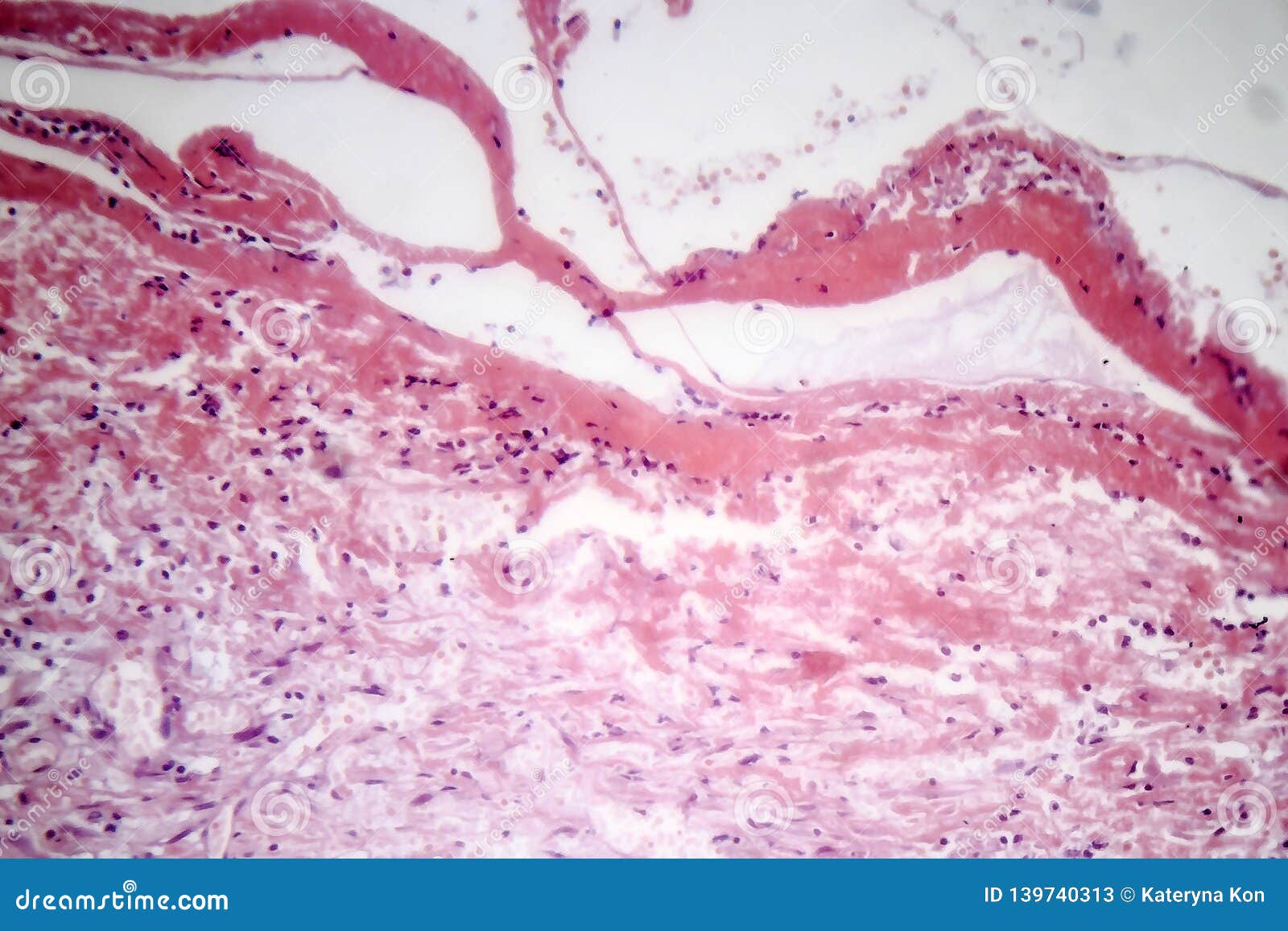 Tuberculous Pleurisy, Light Micrograph Stock Image - Image of stain ...