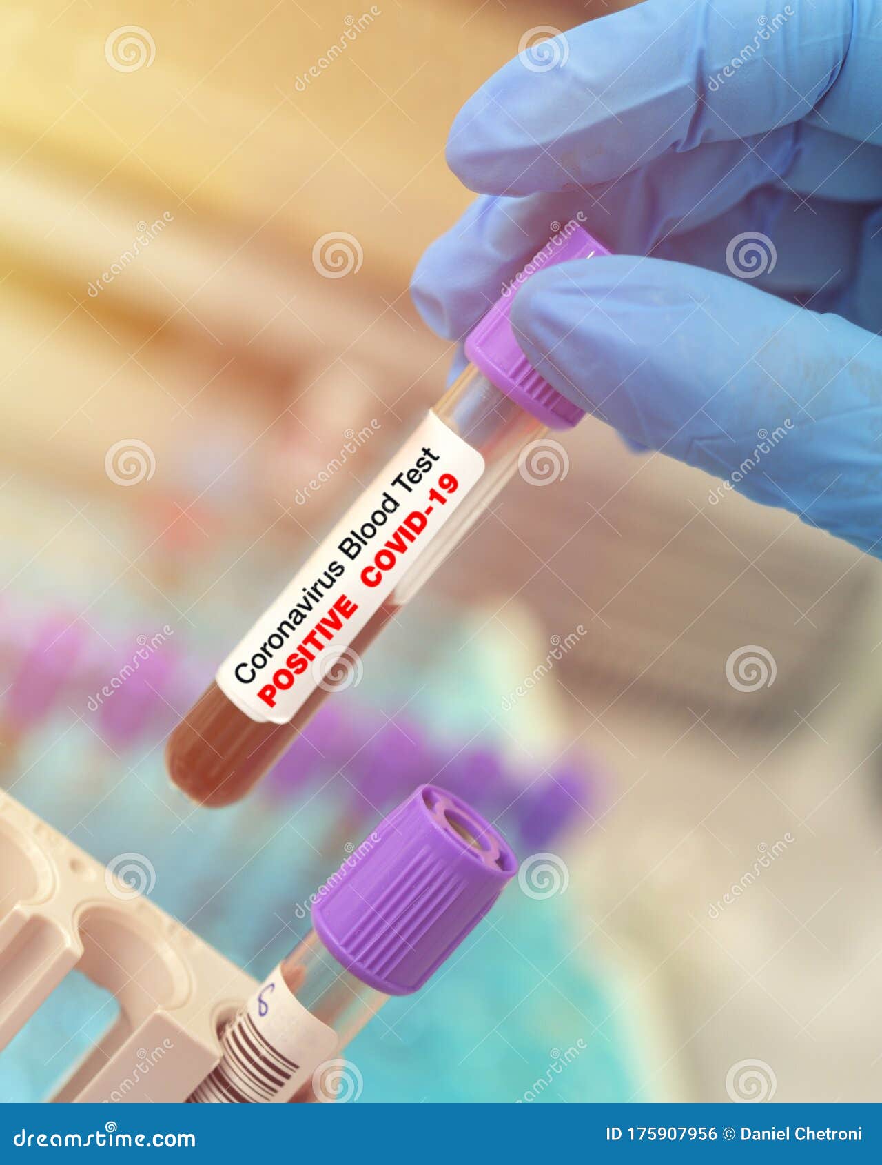 Tubes of Blood Sample for Coronavirus COVID-19 Testing. Positive COVID ...