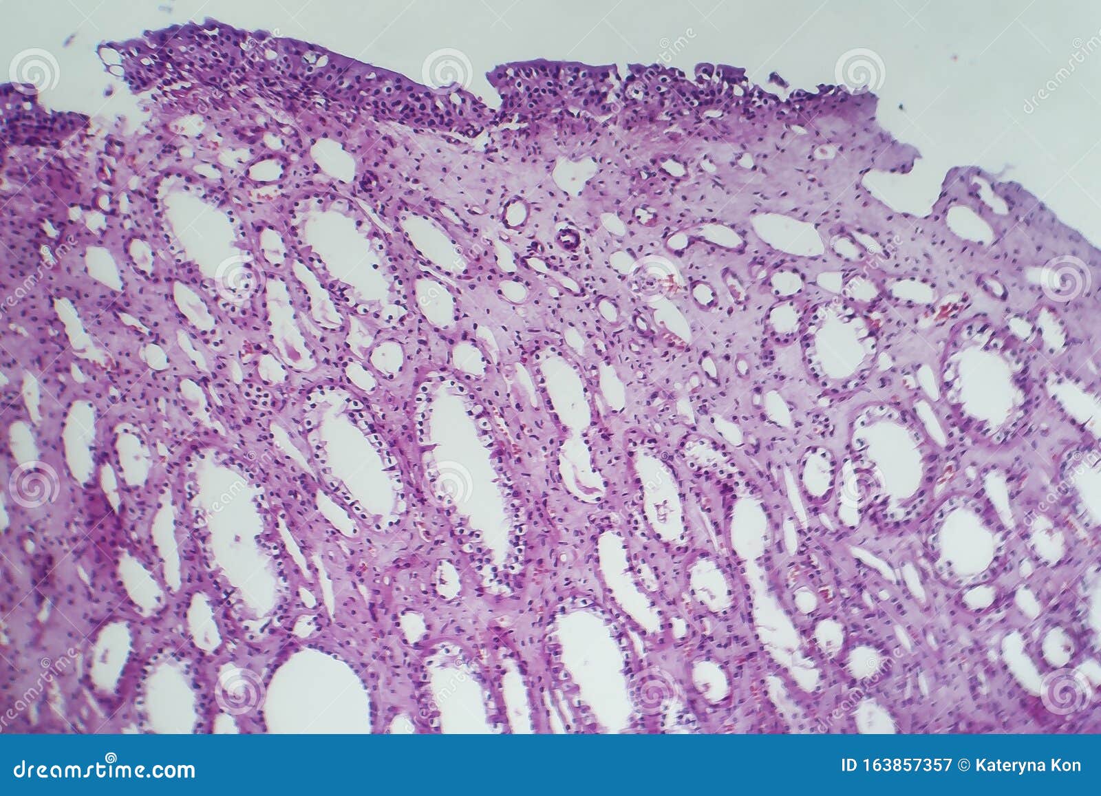 Tubular Atrophy, Light Micrograph Stock Image - Image of micro, atrophy ...