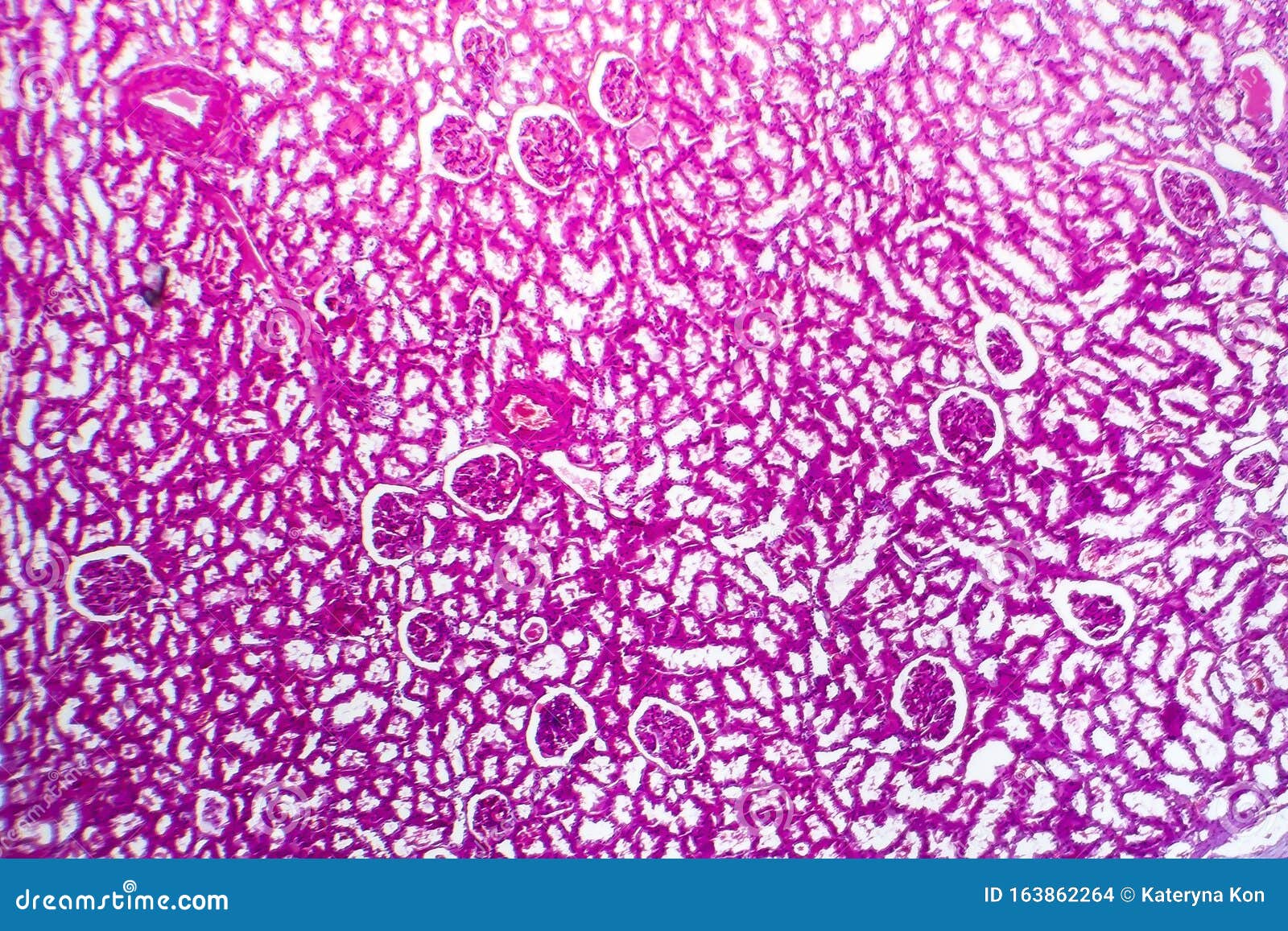 Tubular Atrophy, Light Micrograph Stock Photo - Image of hematoxylin ...