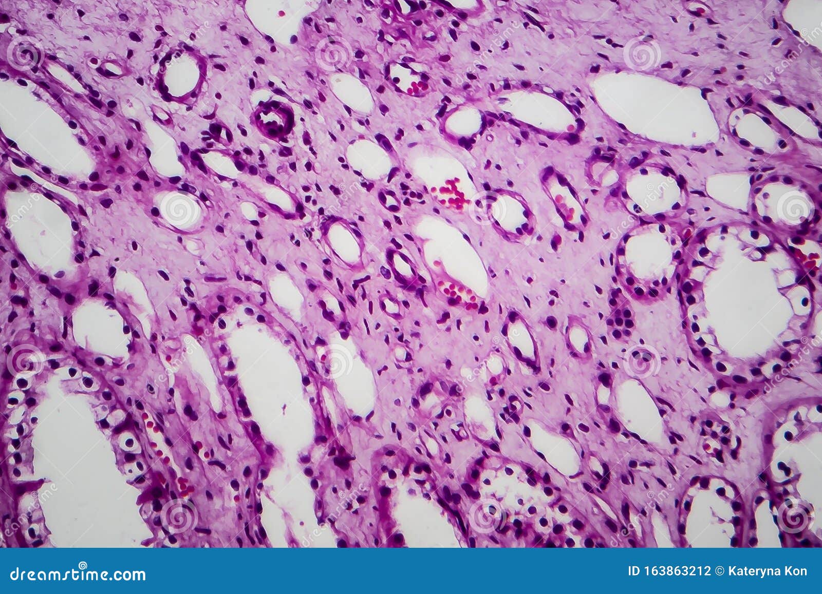 Tubular Atrophy, Light Micrograph Stock Photo - Image of micrograph ...