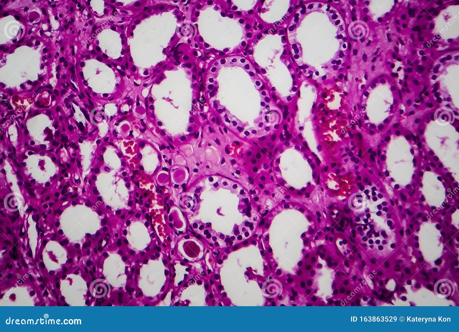 Tubular Atrophy, Light Micrograph Stock Image - Image of ...