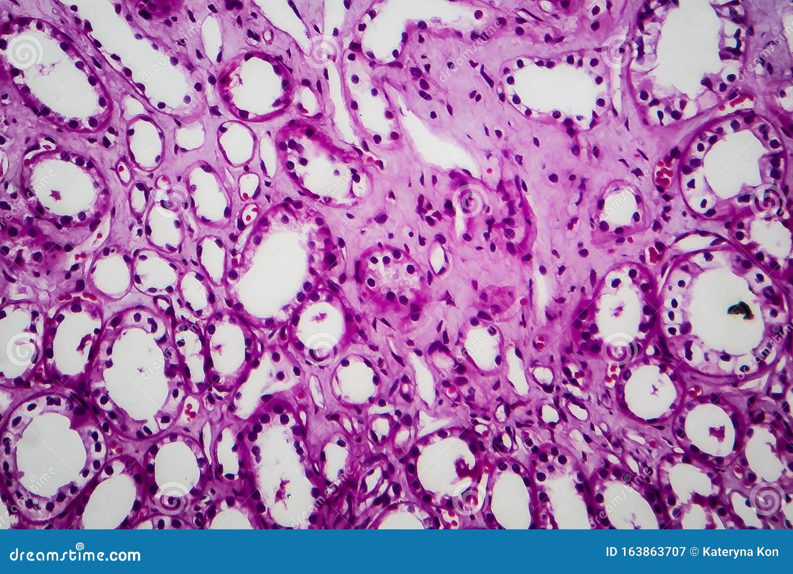 Tubular Atrophy, Light Micrograph Stock Image - Image of microscope ...