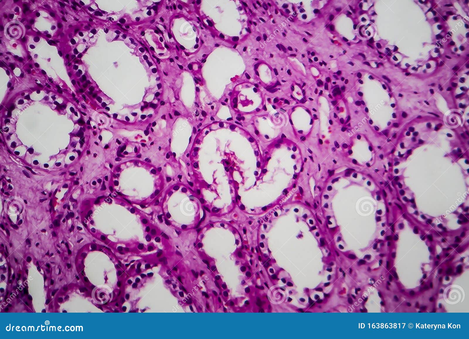 Tubular Atrophy, Light Micrograph Stock Image - Image of pathology ...