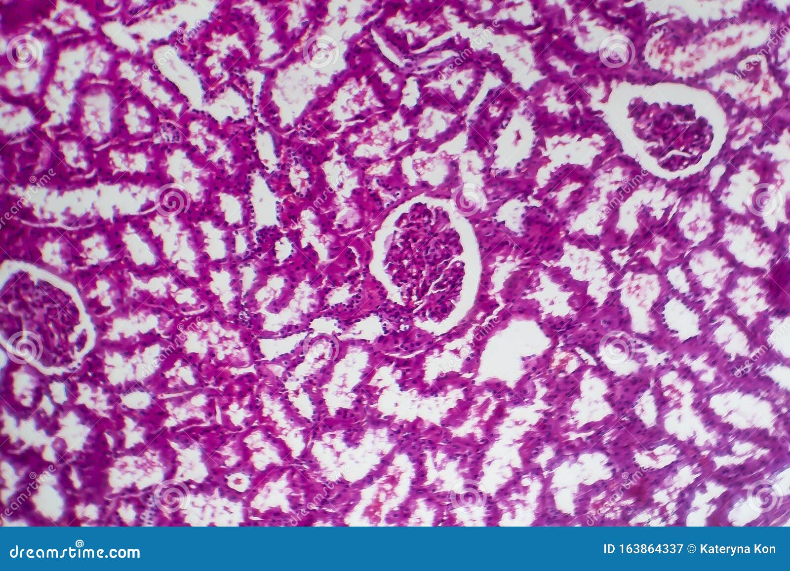 Tubular Atrophy, Light Micrograph Stock Image | CartoonDealer.com ...