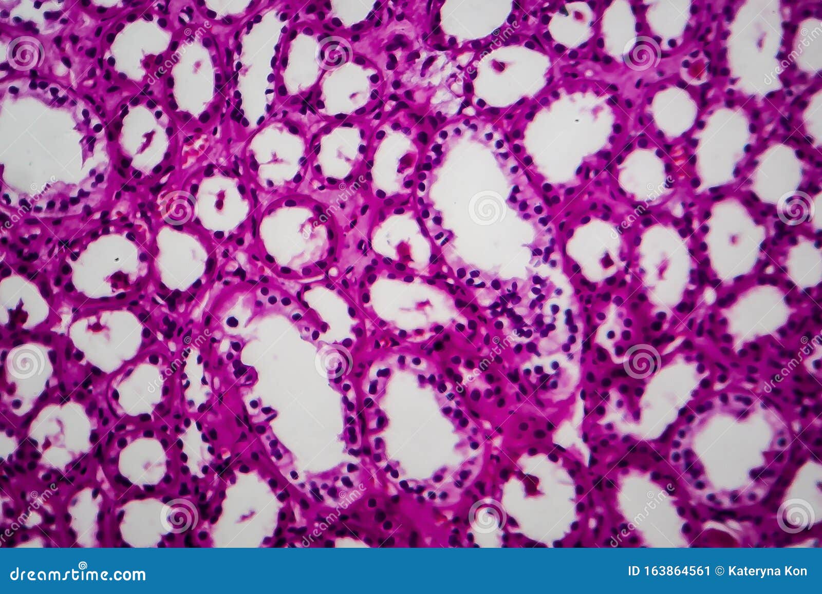 Tubular Atrophy, Light Micrograph Stock Image | CartoonDealer.com ...