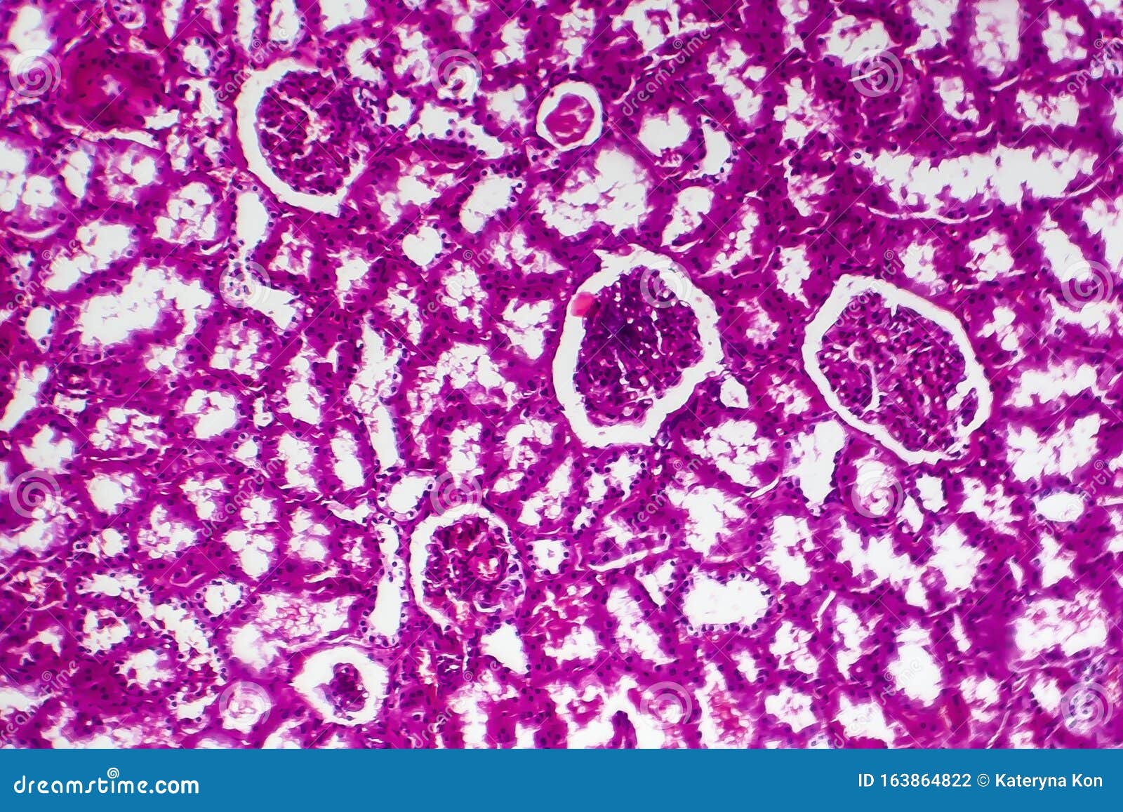 Tubular Atrophy, Light Micrograph Stock Photo - Image of ...