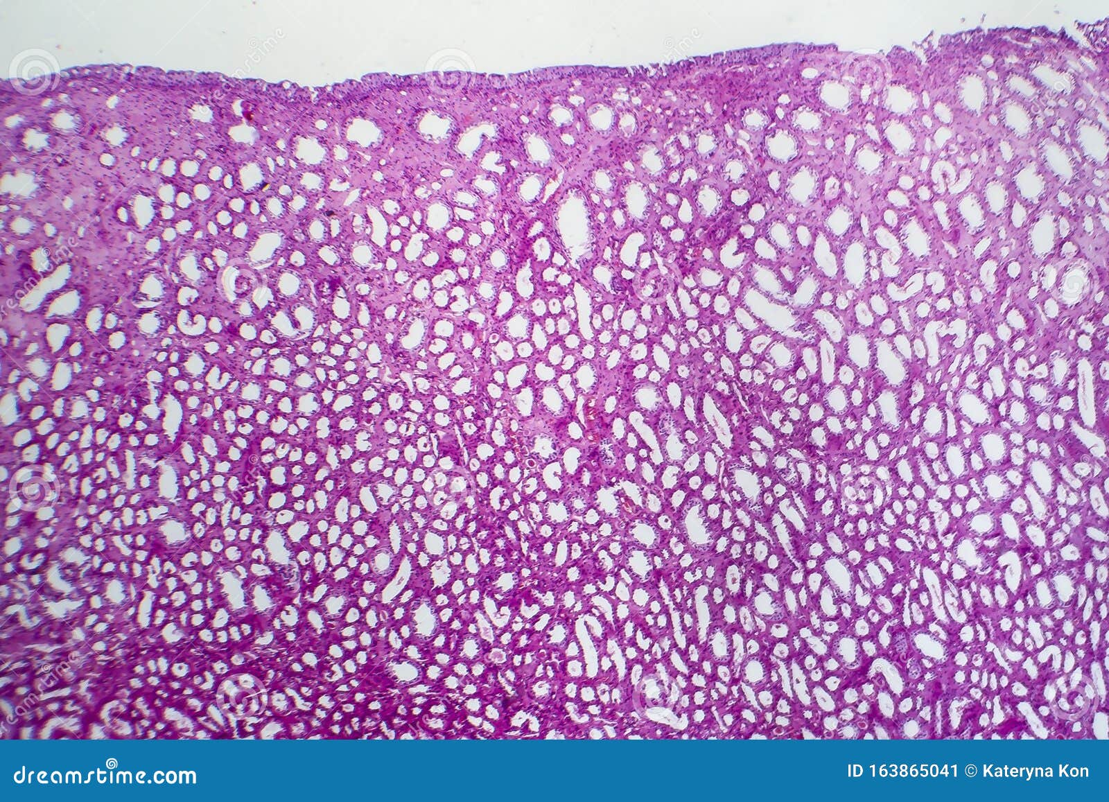 Tubular Atrophy, Light Micrograph Stock Image - Image of hematoxylin ...