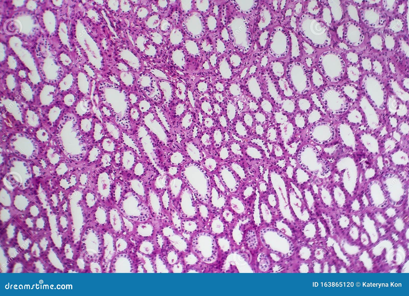 Tubular Atrophy, Light Micrograph Stock Photo - Image of cell ...