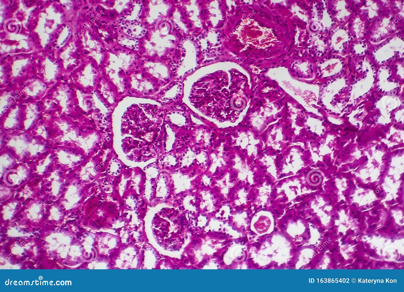 Tubular Atrophy, Light Micrograph Stock Photo - Image of histology ...