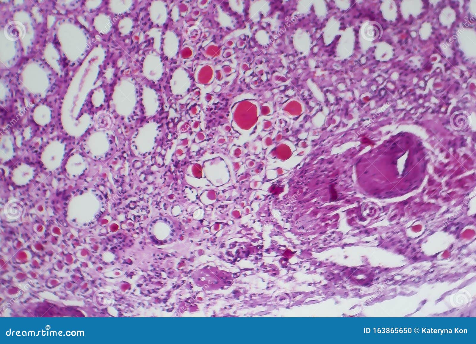 Tubular Atrophy, Light Micrograph Stock Photo - Image of morphological ...